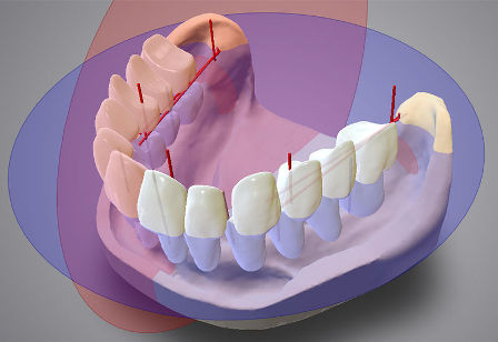 DWOS_FD_3_placement_occlusal_pla.png